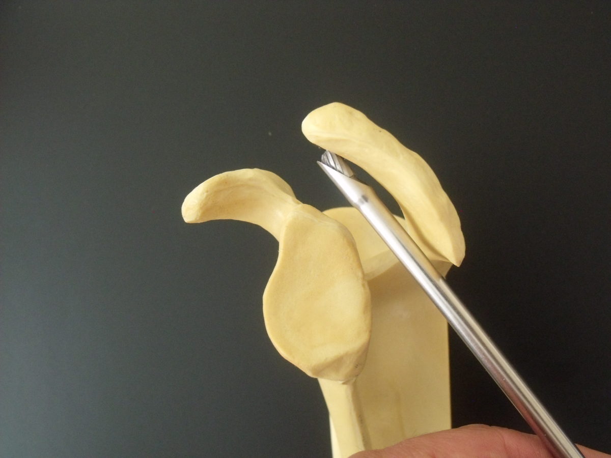 Conflit sous acromial - epaule Toulouse