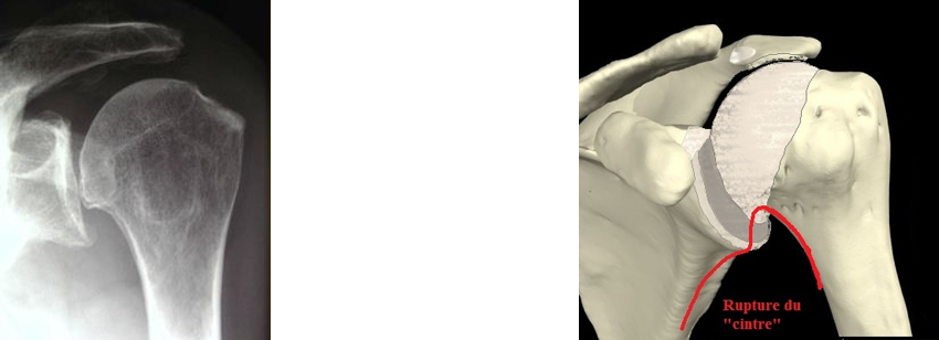 Arthrose de l’épaule | epaule Toulouse