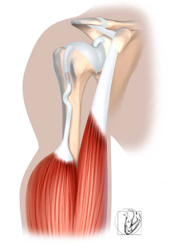 Pathologie du long biceps - epaule Toulouse